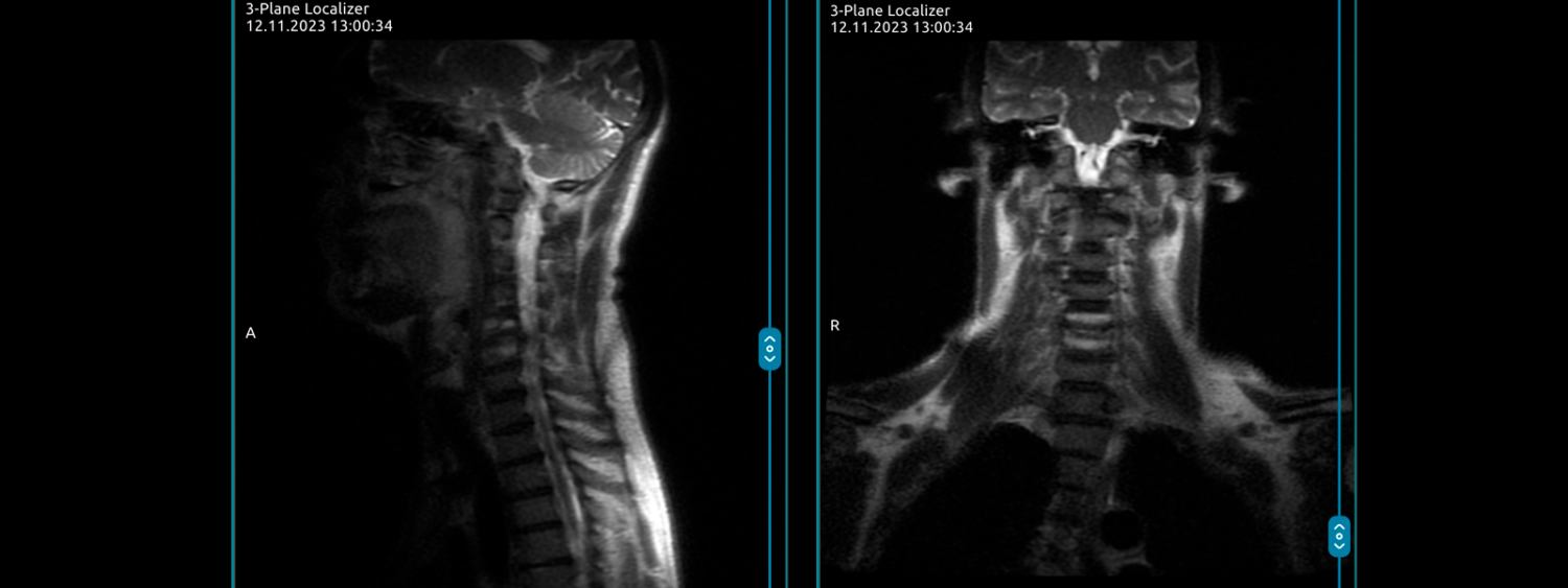 Edema Oseo cuerpo vertebral C5 y C6. Hernias discales C7 a D3 - Terapia ...