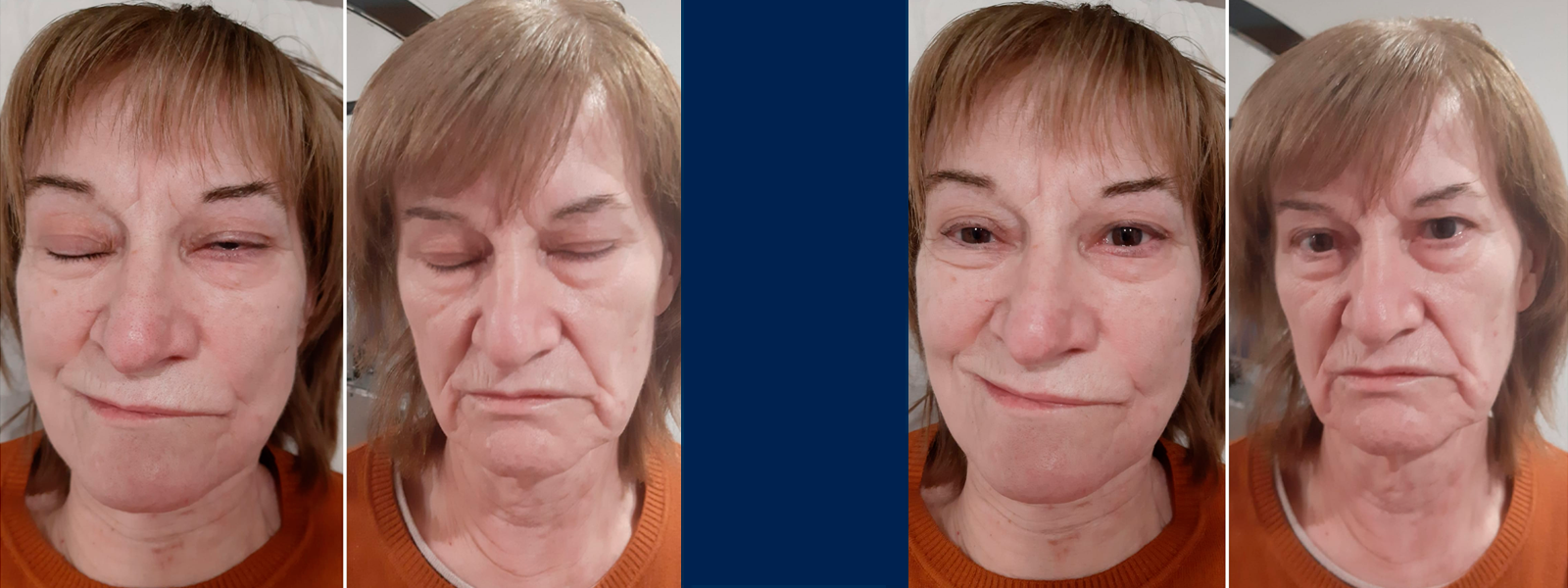 Parálisis Facial Post Herpes Zoster - Terapia Diamágnetica